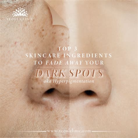 Top 3 Skincare Ingredients To Fade Dark Spots Xeoul Clinic