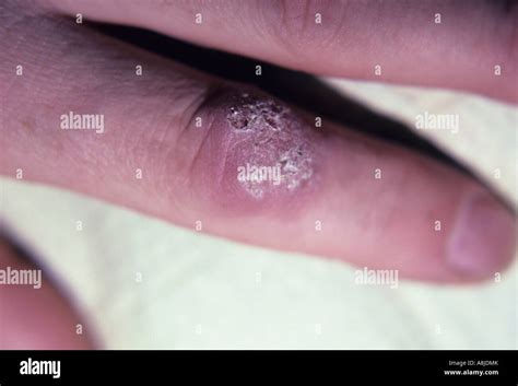 Verruca Stock Photos Verruca Stock Images Alamy