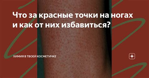 Что за красные точки на ногах и как от них избавиться Химия в твоей