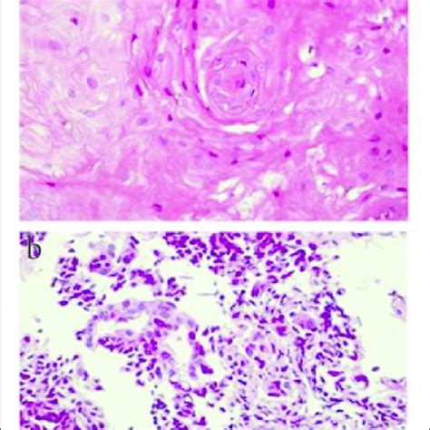 Poorly Differentiated Esophageal Scc A Hyperplastic Stratified
