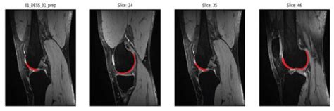 Femur Cartilage Segmented Image Segmentation Quality Is Measured