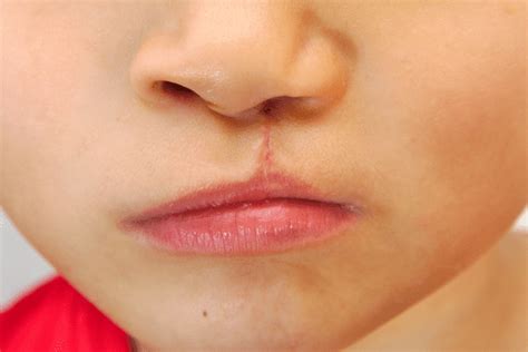 Wanneer Wordt Een Litteken Eindelijk Wit Bapscarcare