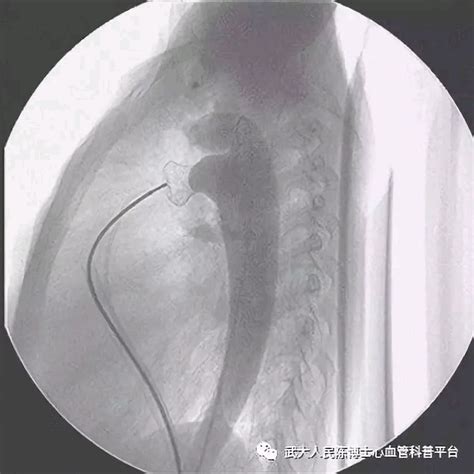 动脉导管未闭的时机和手术方式 春雨医生