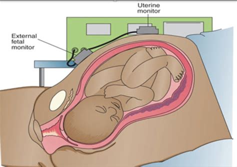 Week 3 Intro To Fetal Monitoring Flashcards Quizlet