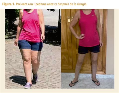 Grados de Lipedema y tipos según zonas afectadas te los lucox cl