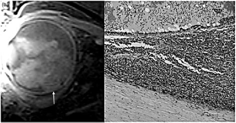 A T1 Weighted Sagittal Contrast Enhanced Image Shows Invasion Of