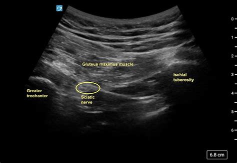 Sciatic Nerve Block Ultrasound