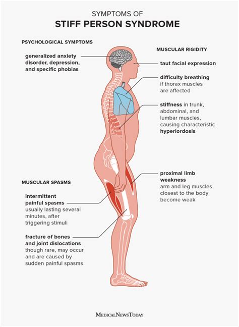 Stiff Person Syndrome Treatment Symptoms And Outlook