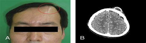 Forehead Abscess Caused By Klebsiella Oxytoca With Undiagnos