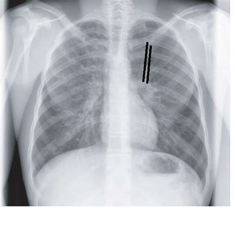 Chest Medicine Made Easy Dr Deepu The Rings The Trams Chest X