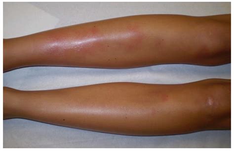Erythema Nodosum African American