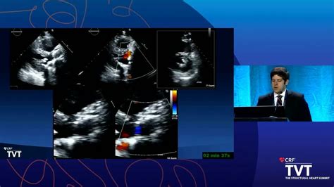 Case Based Laao Pre Procedural Considerations