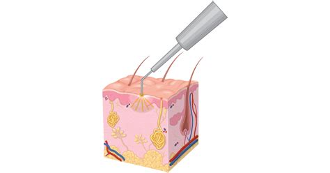 Diathermy For Skin Procedures In Auckland Skintel