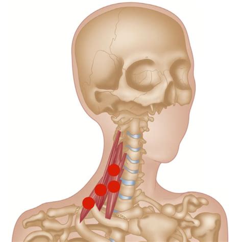 Trigger Point Therapy Treating The Scalenes Release Techniques Trigger Points Trigger