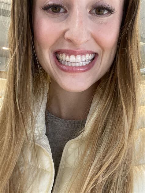 8 Refinement Trays A Rubber Band For The First Time Come On Stubborn Midline Finish Shifting