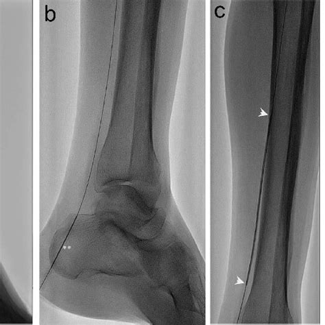 A D Initial Angiogram Showing Completely Occluded Distal Posterior