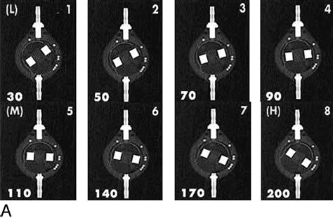Brg Reading Skull Films For Shunt Valve Settings
