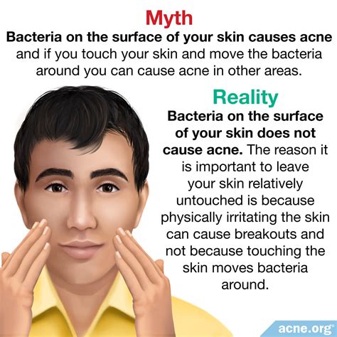 Acne Myths