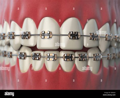 Teeth With Braces Or Brackets In Open Human Mouth Dental Care Concept