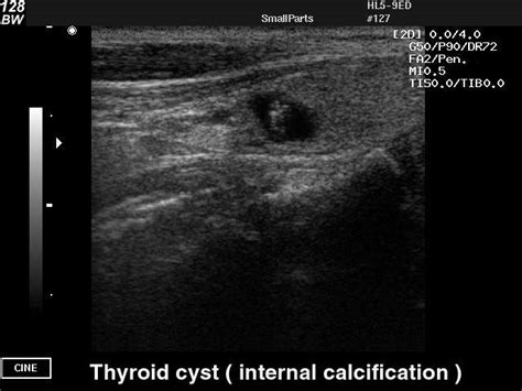 Ultrasound Thyroid Cyst With Calcification B Mode Echogramm №43