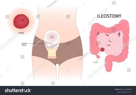 Colostomy Stoma