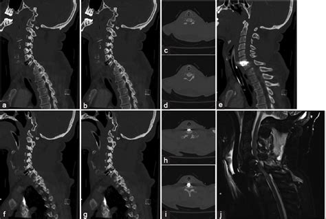 Bilateral Cervical Facet Dislocations At Two Adjacent Levels A Case Report Surgical Neurology