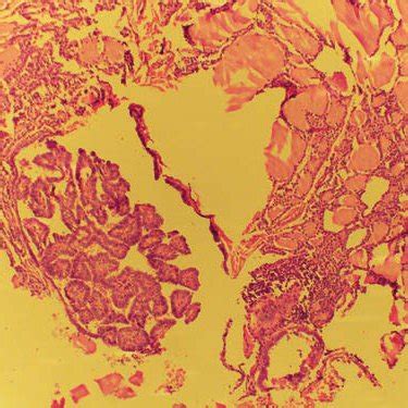 Papillary Carcinoma With Chronic Nonspecific Lymphocytic Thyroiditis