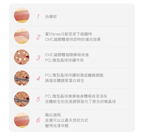 Ellanse洢蓮絲、依戀詩 三合一注射填充劑 德榮醫美 德榮醫美腋下除毛除毛微晶瓷淨膚雷射 張榮裕德榮醫美02 3312 4633