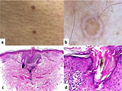Translated Article Is Follicular Porokeratosis A Distinct Clinical