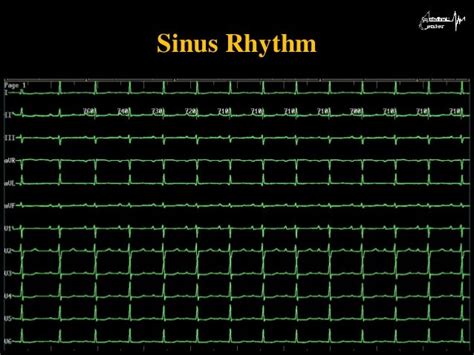 Ablation Of Atypical Flutter