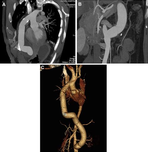 Postoperative Computed Tomography Angiography CTA Shows The Ascending