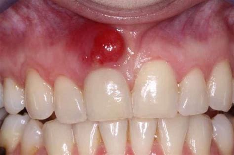 Abscess Tooth Infection