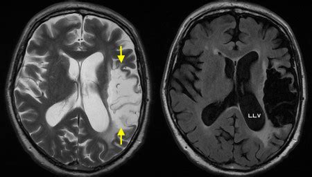 Encephalomalacia Due To Old MCA Infarct Radiology At St Vincent S University Hospital