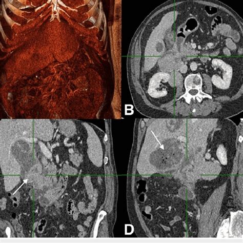 Cect With An Invasive Duodenal Hcc Nodule Cect One Week After The