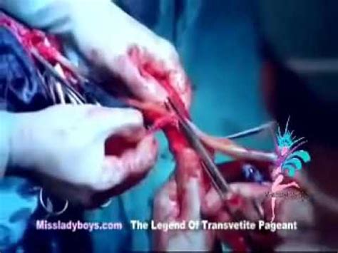 Rosie S Botched Sex Change Surgery YouTube