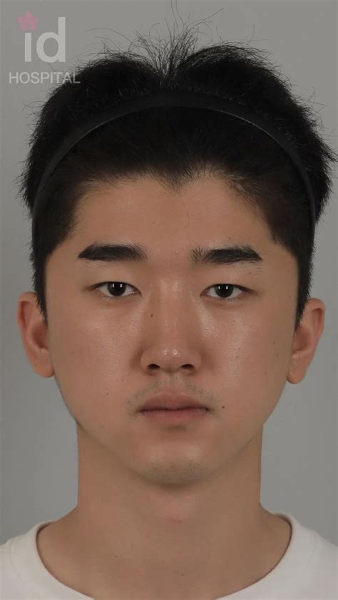 Солонгосын Id гоо сайхны эмнэлэг АЙДИ хацрын унжилт арилгах утас суулгах хагалгаа эрүү