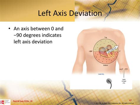 Ppt 12 Lead Ecgs And Electrical Axis Powerpoint Presentation Free Download Id 5490745