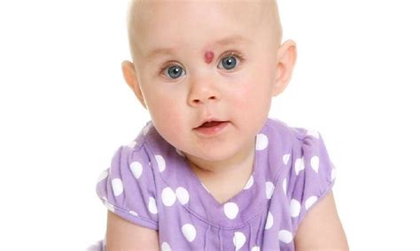 Apa Itu Hemangioma Berikut Pengertian Jenis Penyebab Gejala
