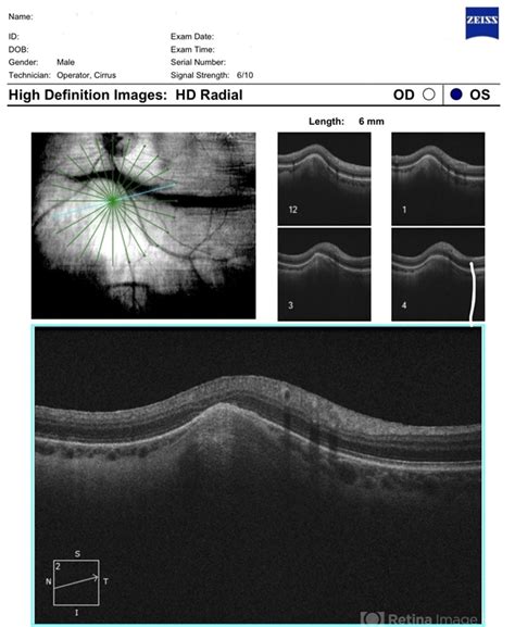 Focal Scleral Nodule Retina Image Bank