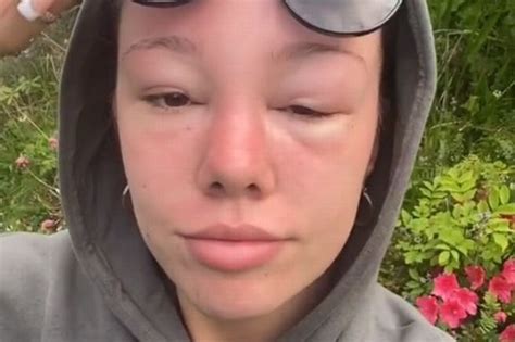 Tiktok Holidaymakers Sun Poisoning Warning After Face Swells Up