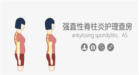 双膝骨性关节炎护理查房ppt下载 Lfppt