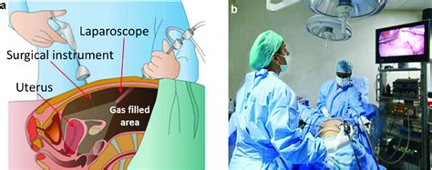 (a): Laparoscopic surgery, (b): Surgeons viewing inside the abdomen on... | Download Scientific ...