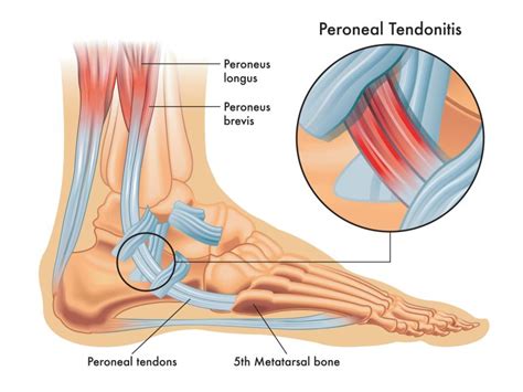 Peroneal Tendonitis