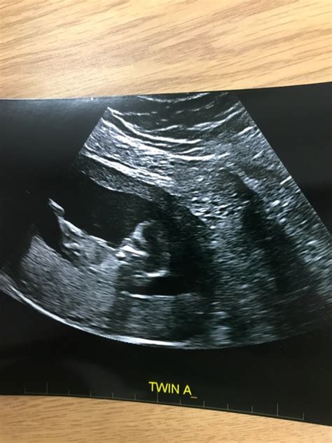 12 Weeks Today And Had Nuchal Translucency Done Glow Community