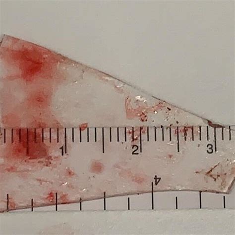 The 35 Cm Glass Foreign Body Identified In The Right Inguinal Region