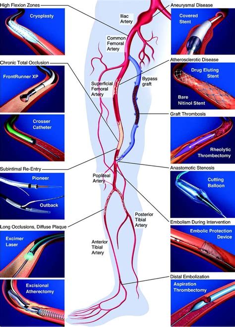 Different Types Of Revascularization Diagnostic Medical Sonography