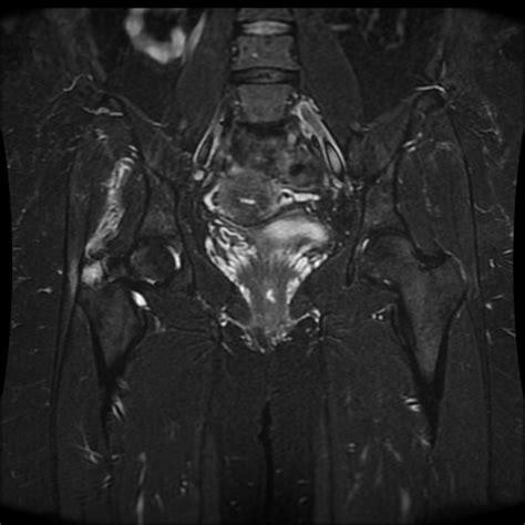 Calcific Tendinitis Of The Gluteus Medius Muscle Image