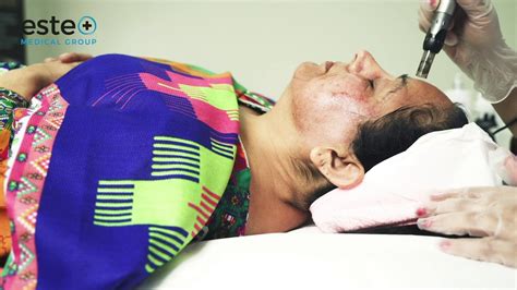 What Is A Dermapen Treatment Este Medical Group Skincare Tips Youtube