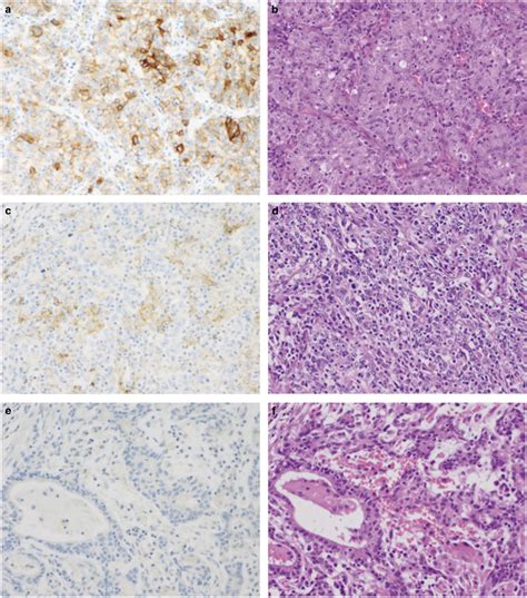 Overexpression And Gene Amplification Of Pd L1 In Cancer Cells And Pd