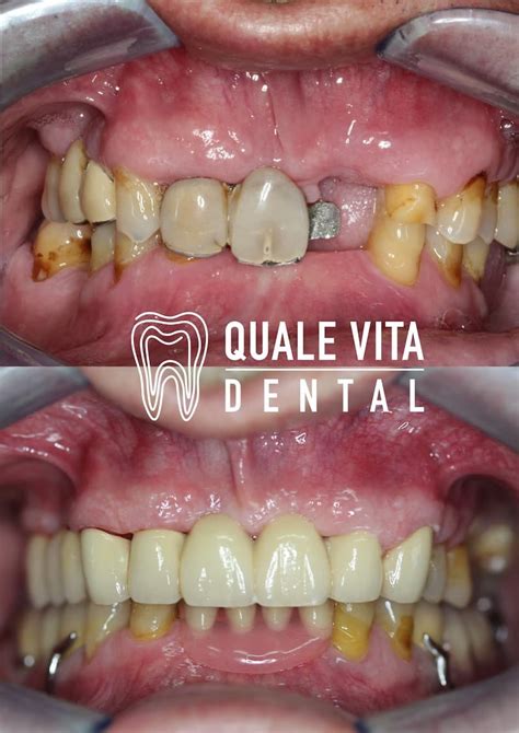 Bridge Fixed Partial Denture Quale Vita